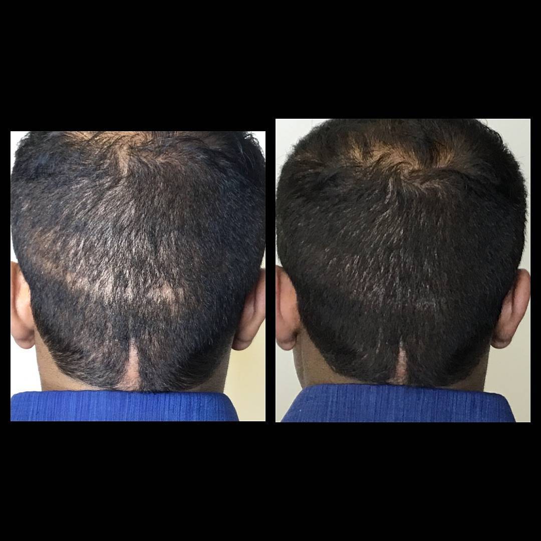 Scar Camouflage | Look Natural Micropigmentation Clinic