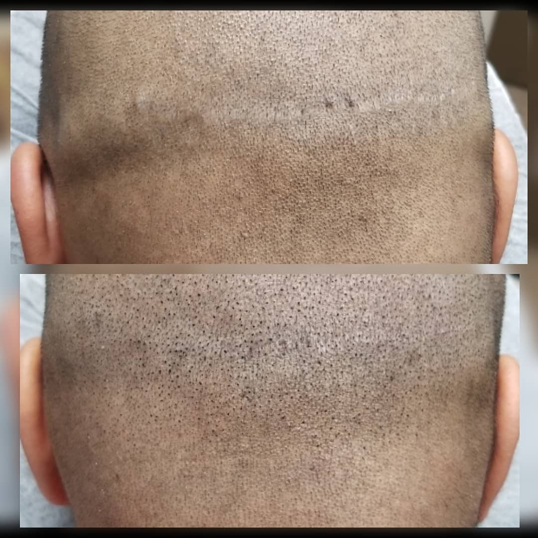 Scar Camouflage | Look Natural Micropigmentation Clinic
