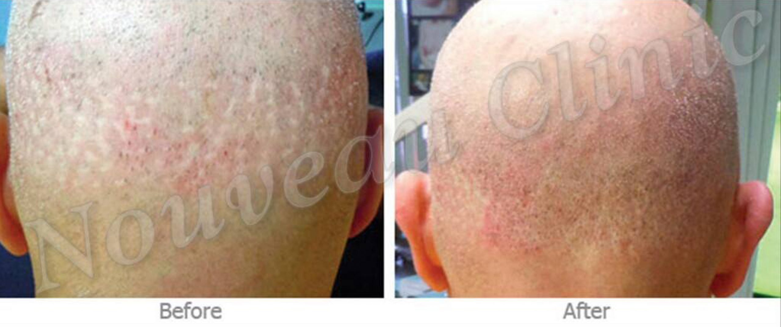 Scar Camouflage | Look Natural Micropigmentation Clinic